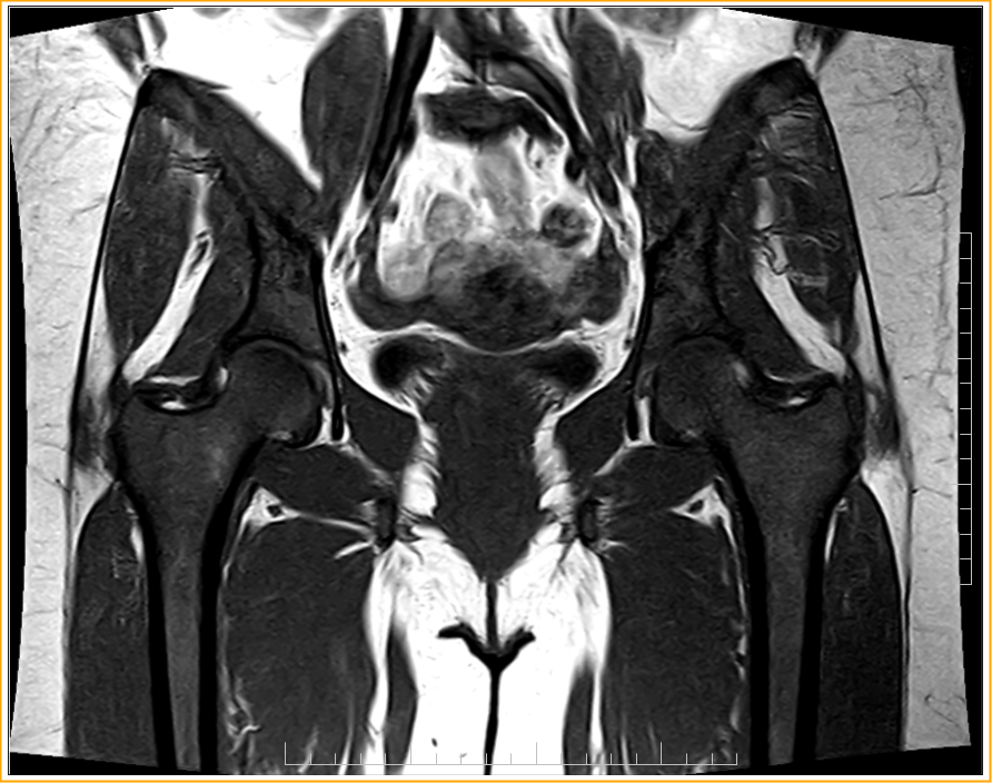MR imaging of bone marrow : NHL - Sumer's Radiology Blog