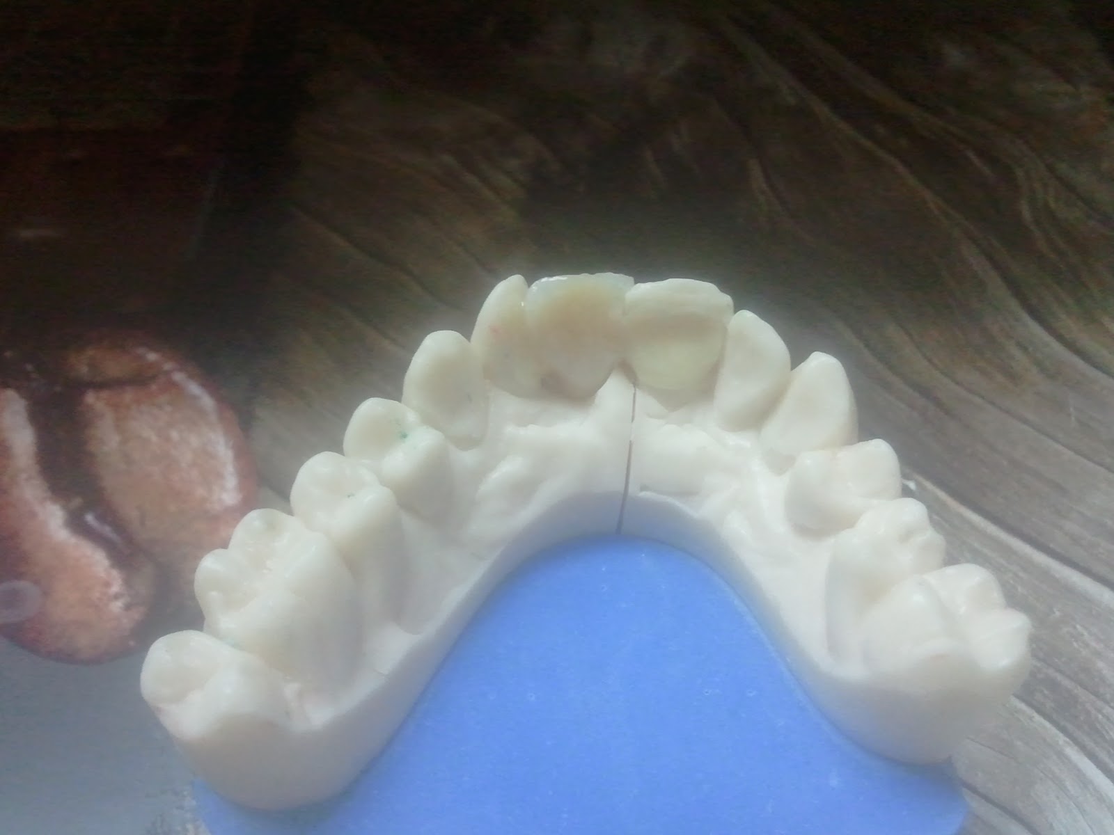 prothèse dentaire le BLOG " Tremel Pascal ": Réalisation d'une centrale ...