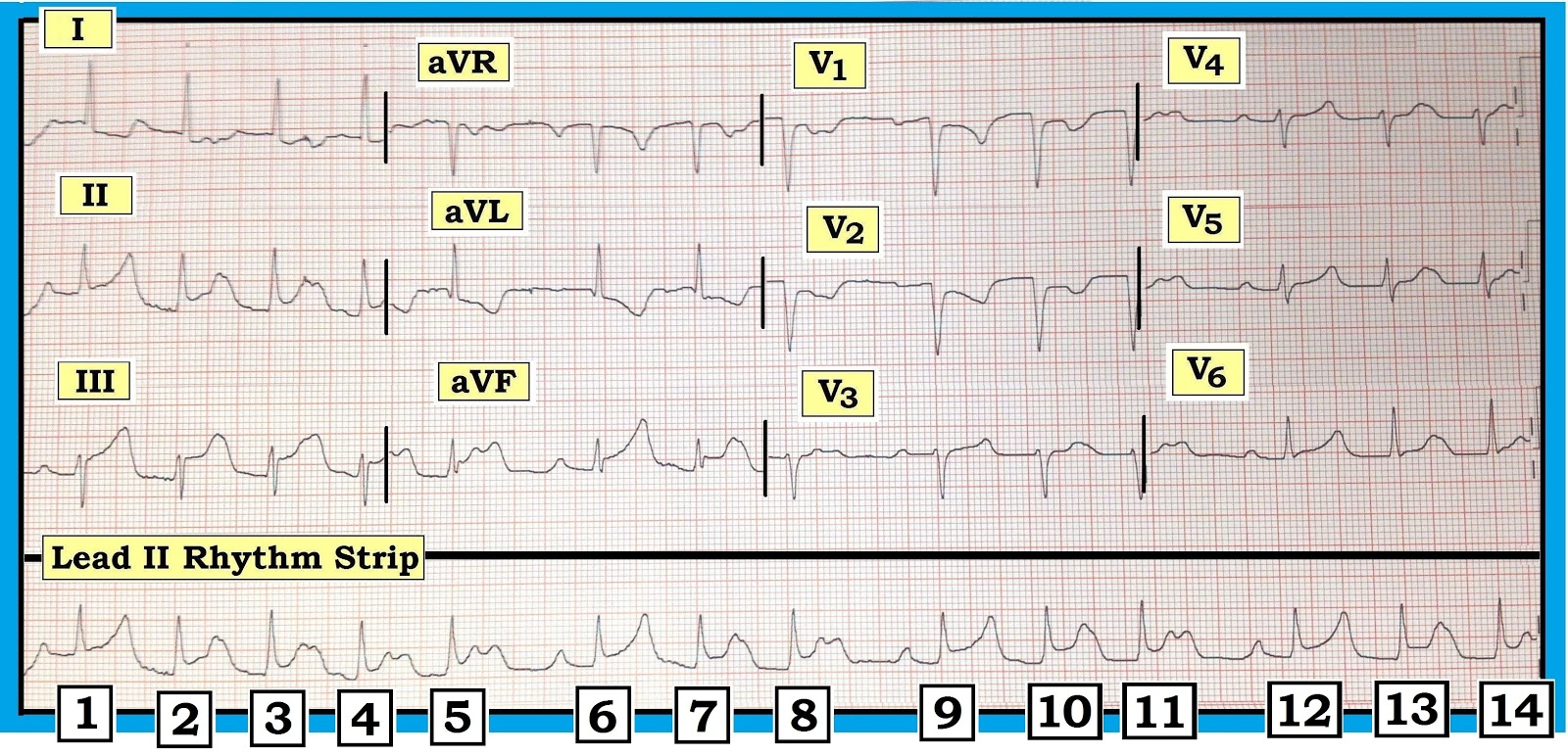 ECG Interpretation: November 2012