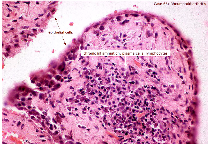 Rheumatoid Arthritis: Histology of RA
