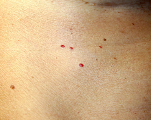 A Quick Way To Get Rid Of Cherry Angiomas (Red Moles) At Home ...