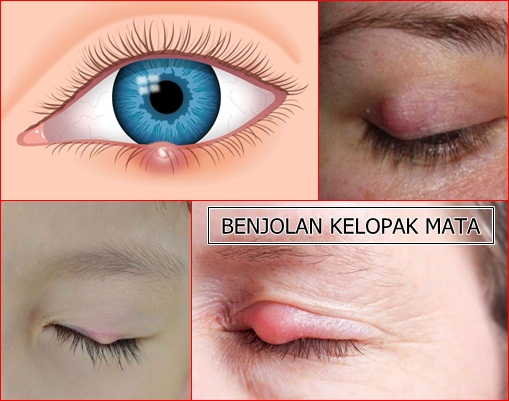 Cara Alami Menghilangkan Benjolan Di Kelopak Mata Bagian Dalam | Obat ...