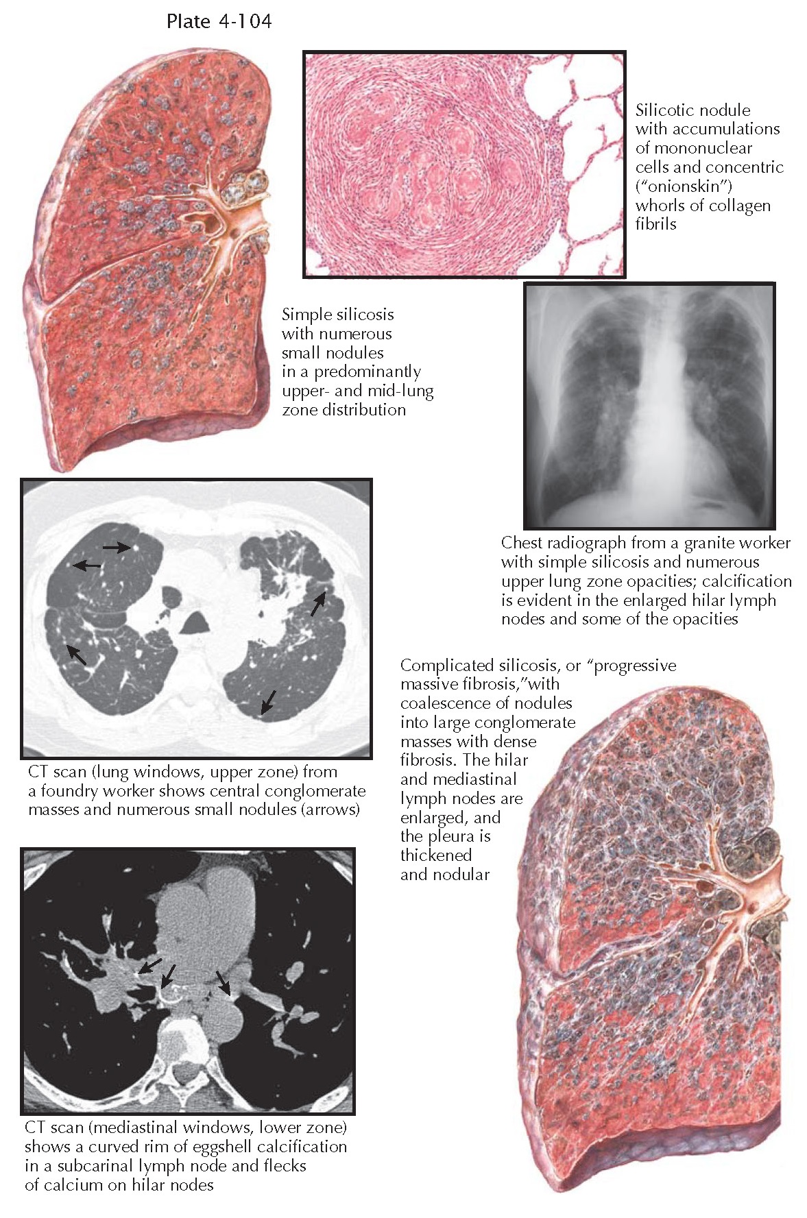 SILICOSIS - pediagenosis