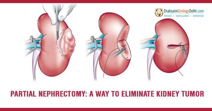 Partial Nephrectomy: A Way To Eliminate Kidney Tumor