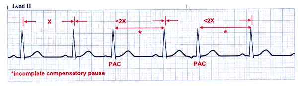Premature Atrial Contraction (PAC) - JANTUNG OKE