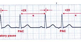 Premature Atrial Contraction (PAC) - JANTUNG OKE