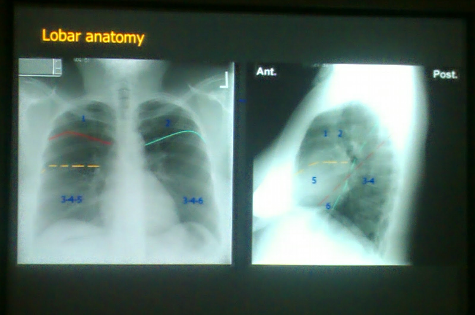 Lecture slides: Radiology: Chest X ray