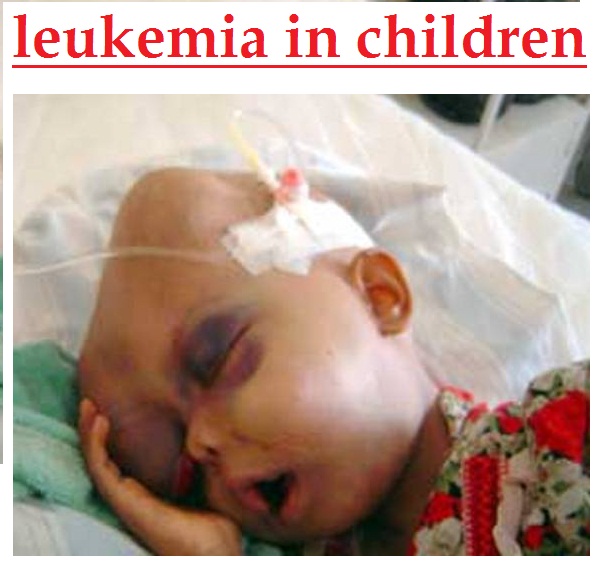 leukemia info: leukemia in children