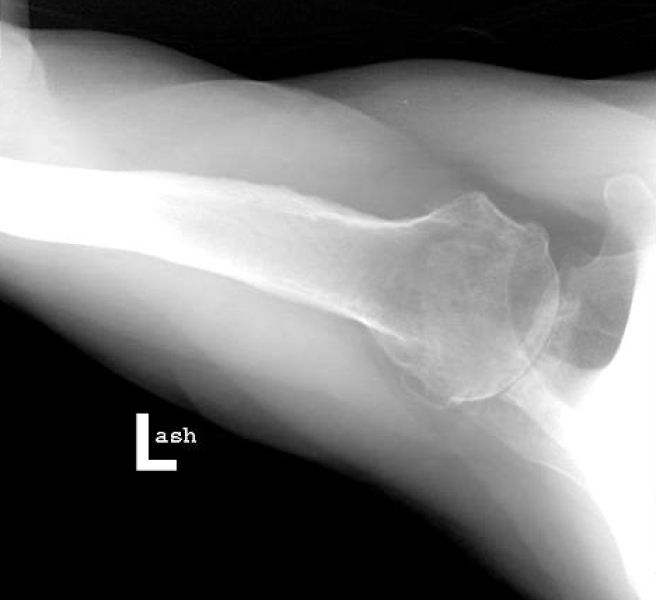 Shoulder and Elbow Surgery: Impaction autografting of the medial calcar ...