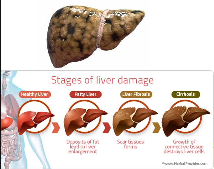 SYARAT DAN PRINSIP DIET PENYAKIT HATI | Nutrition