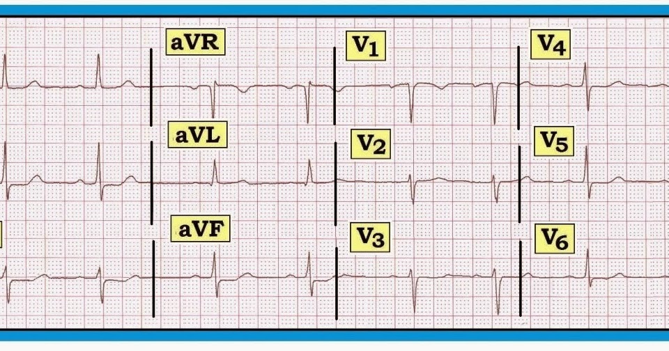 ECG Interpretation: ECG Interpretation Review #84 (ST Depression – ST ...
