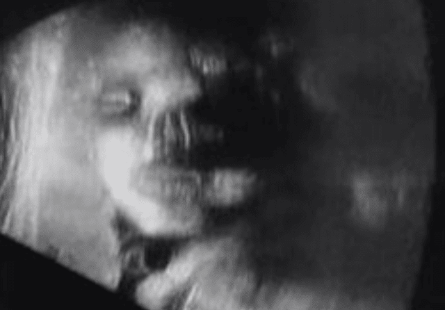 5 Creepy Ultrasound Pictures That Will Make You Question Having ...