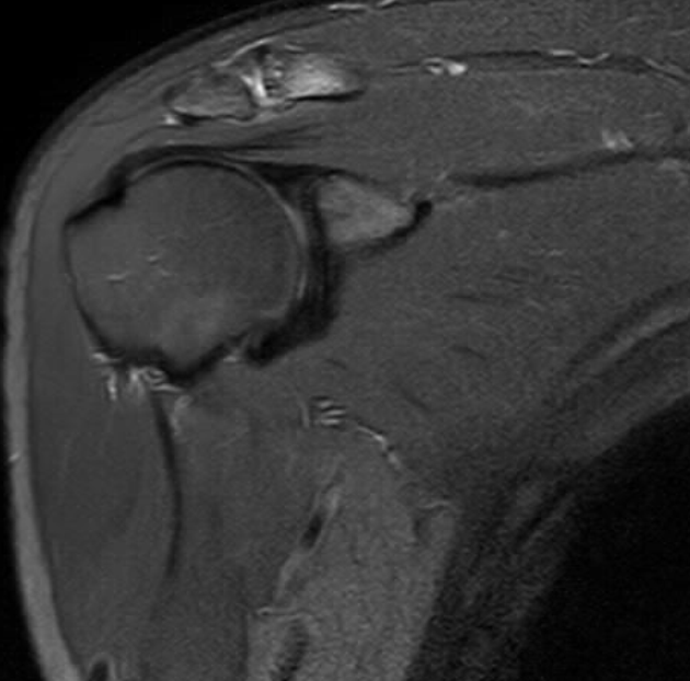 Acromioclavicular junction injury-MRI - Sumer's Radiology Blog