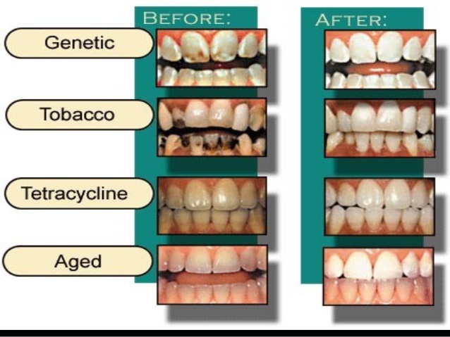 Dental Bleaching Technique