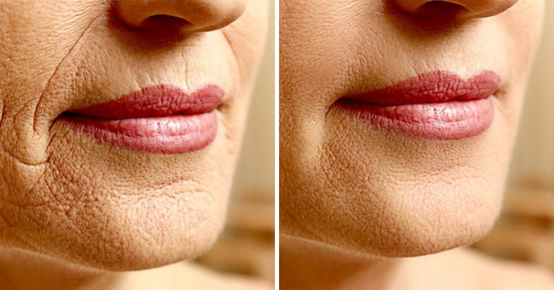 15 Science-Backed Remedies To Minimize Wrinkles And Look Younger