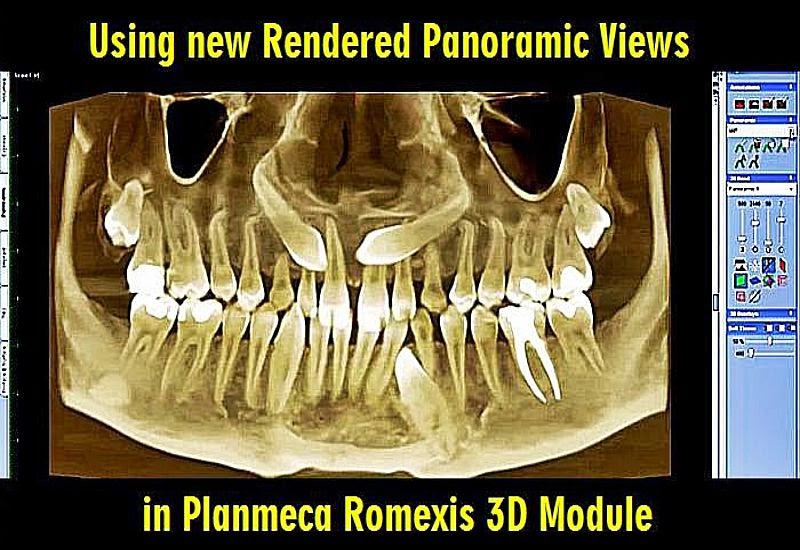 DENTAL RADIOGRAPHY: Using new Rendered Panoramic Views in Planmeca ...