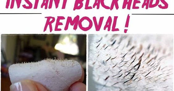 Say goodbye blackheads in 15 minutes ! - medicine health life