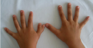 Triphalangeal Thumb Definition, Symptoms, Causes, Treatment, Anemia ...