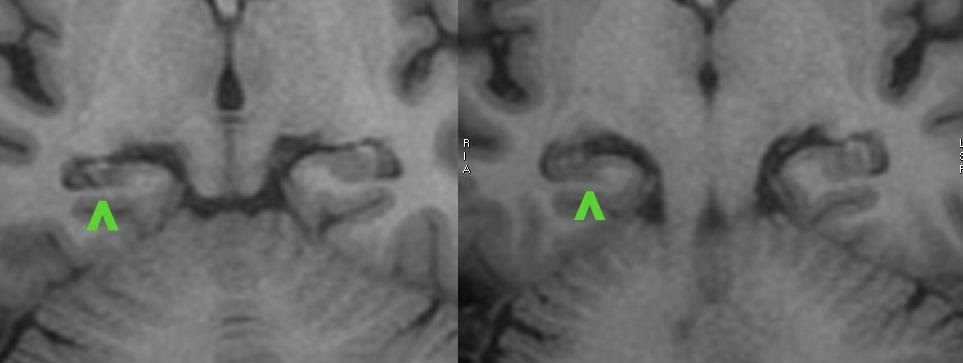 Neuroradiology Cases: Mesial temporal Sclerosis MRI