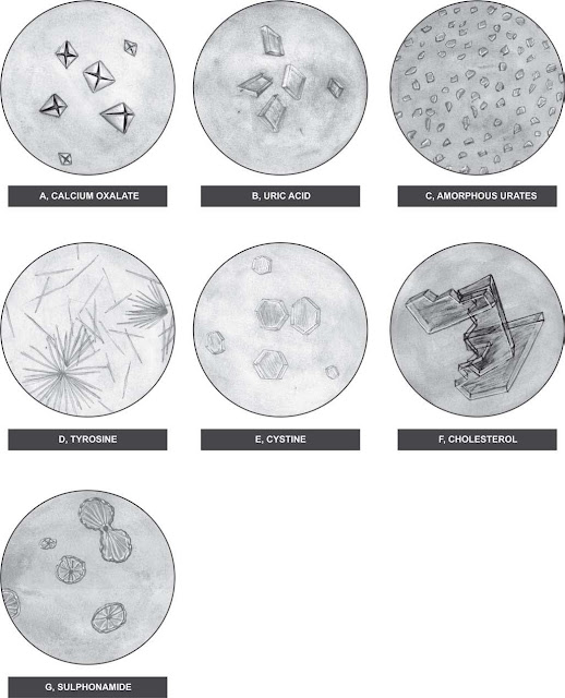 Crystals in Urine: Acidic Urine