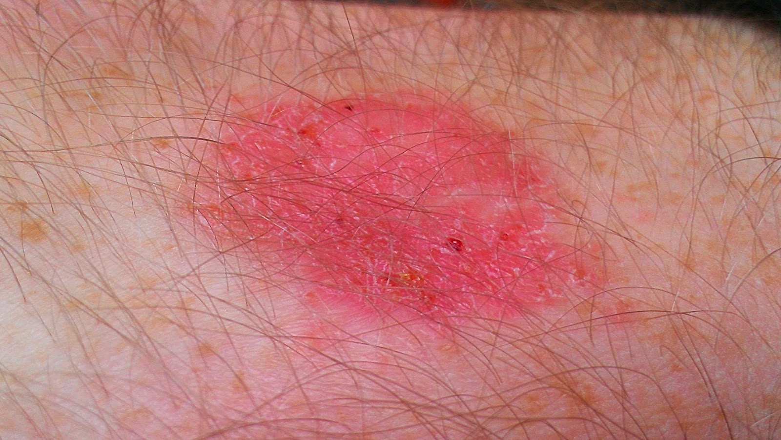 SKIN DISEASE TYPES: Nummular Dermatitis
