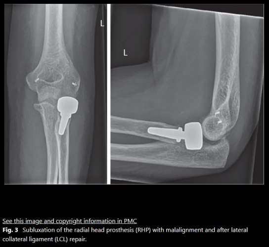 Revisiones_bibliográficas TyO_Web: Manejo de la artroplastia de cabeza ...