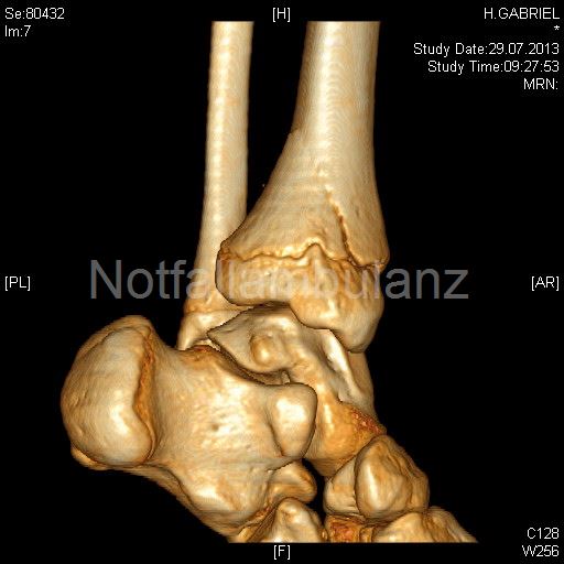 Brennpunkt Notaufnahme: Fall 16: Kindliche Distorsion des OSG: Triplane ...