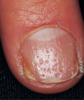 Nail pitting: Nail pitting causes