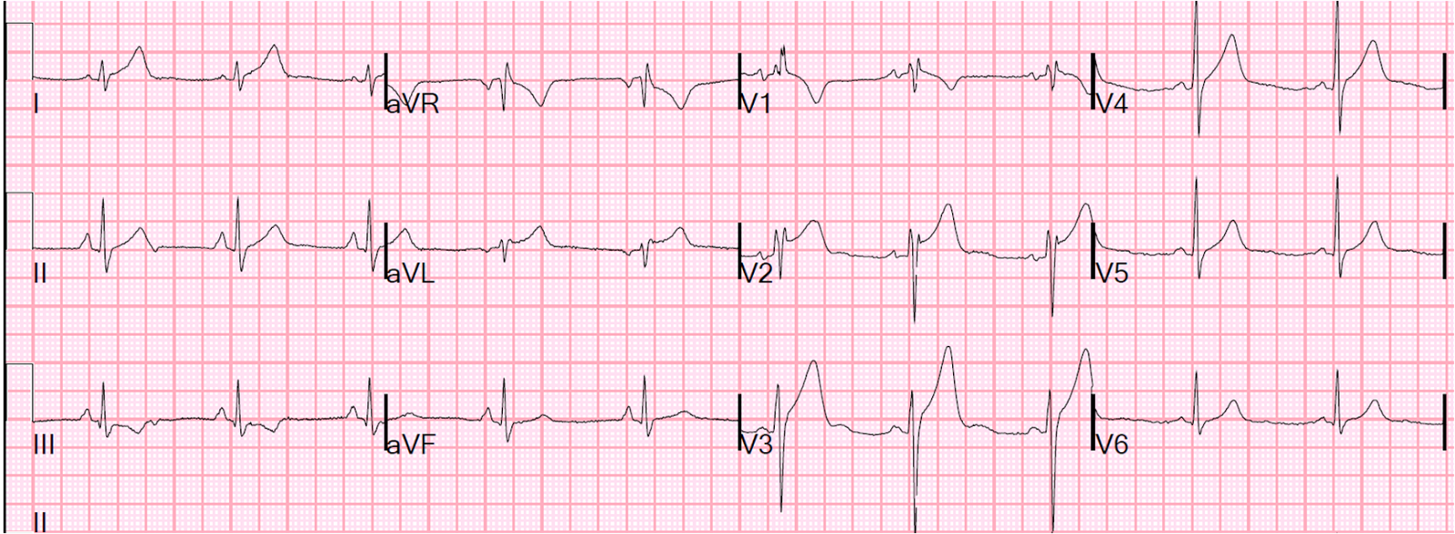 Dr. Smith's ECG Blog: Epigastric pain, Syncope, and Saddleback ST Elevation