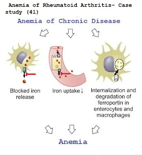 Case study (41) - Anemia of Rheumatoid Arthritis.