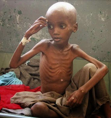 GIZI BURUK ( KWASHIORKOR DAN MARASMUS )