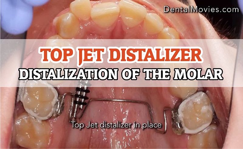 TOP JET DISTALIZER: Distalization of the molar - Odonto-Tv