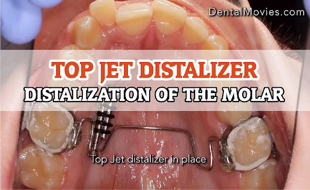 TOP JET DISTALIZER: Distalization of the molar