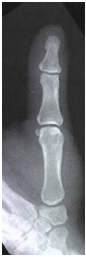 Study of the Thumb (First Digit) | Radiology