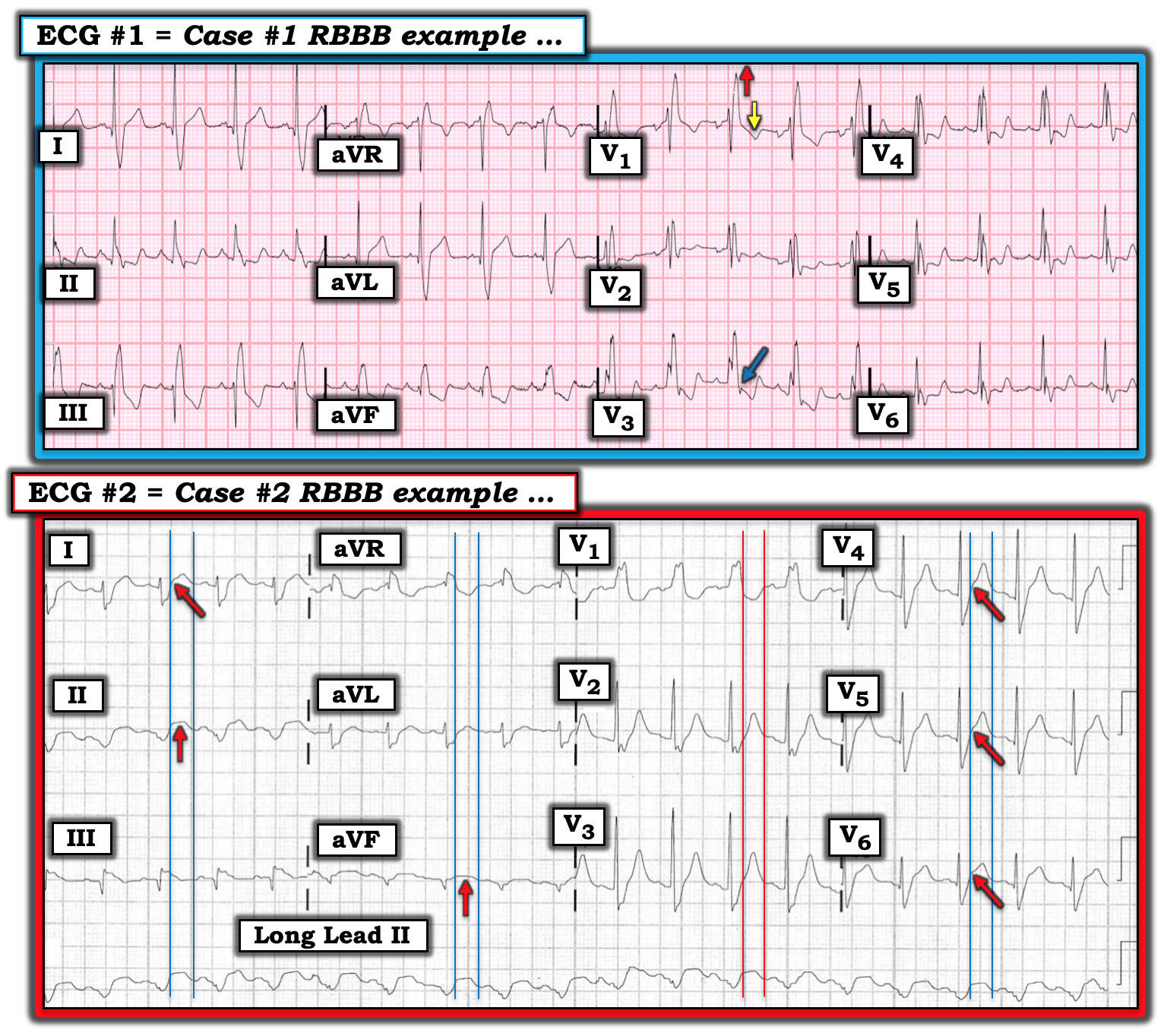 Dr. Smith's ECG Blog: Two patients with RBBB