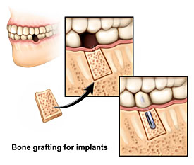 Why Do Most Places Use Synthetic Bone Graft Materials? | Tooth implant