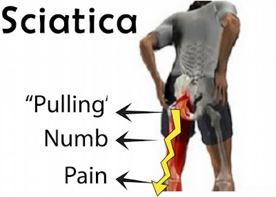 Sciatica treatments: Sciatica exercises