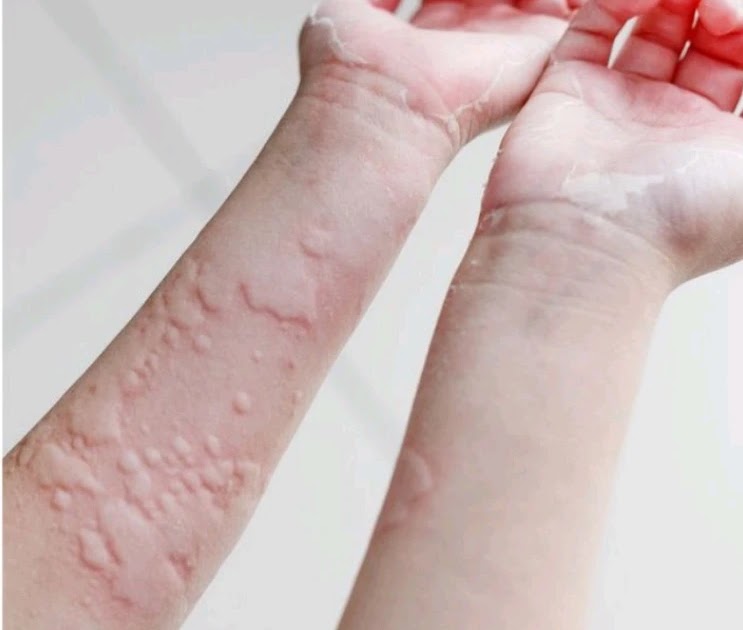 Obat Gatal Alergi Dingin Di Apotik - Tips Cara Mudah