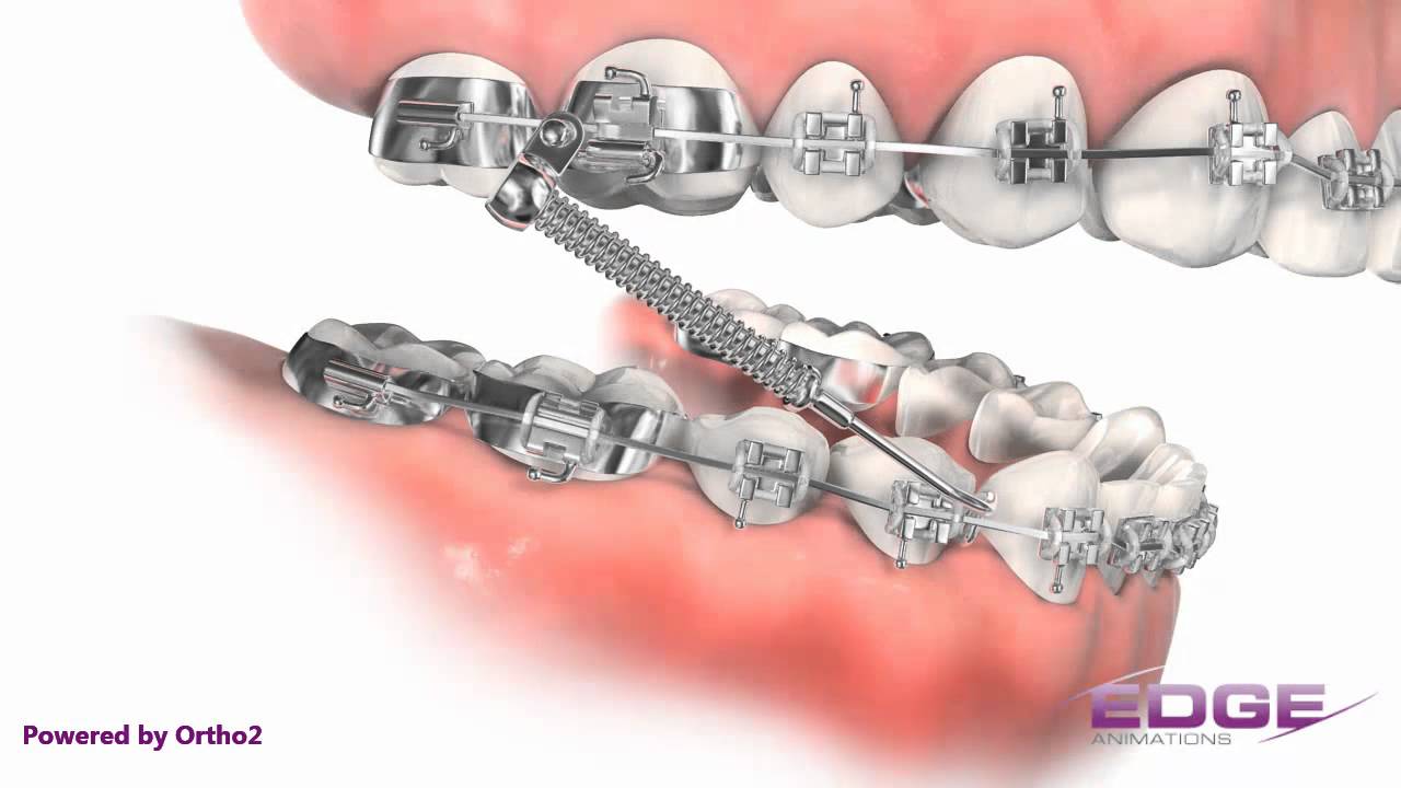 Aparat Herbsta - moja przygoda