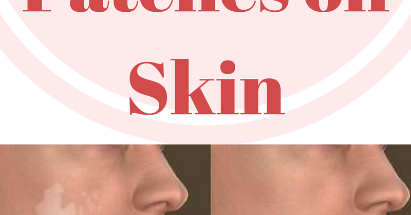 How to Get Rid of White Patches on Skin