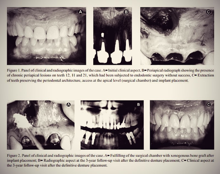 PDF: Immediate implants placed into infected sockets: a case report with 3-year follow-up ...