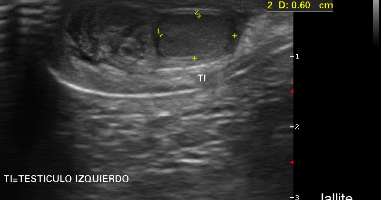 Hernia Inguino-Escrotal Incarcerada