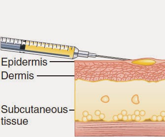 Administering Intradermal Medication ~ Nursing