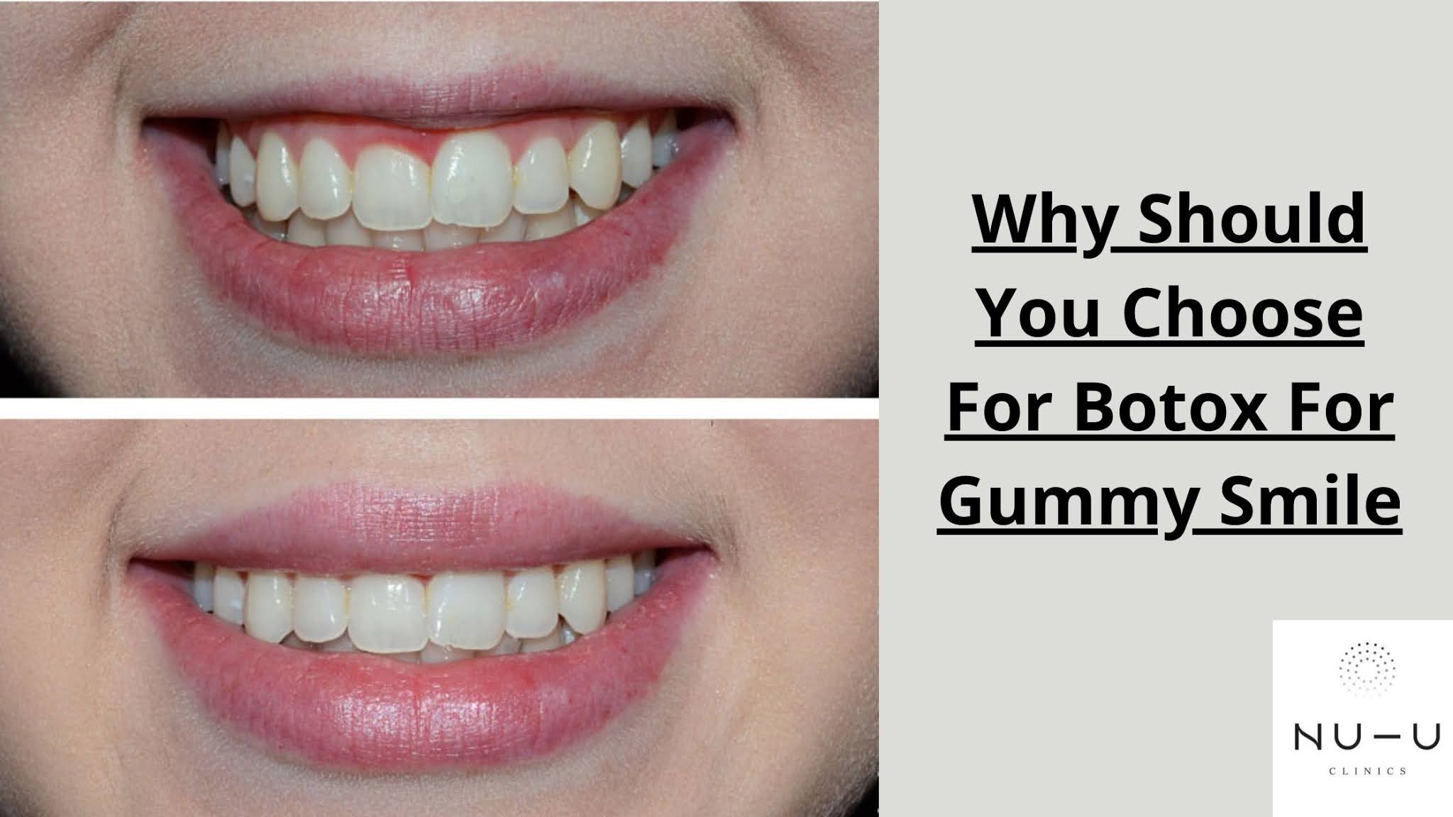 Why Should You Choose For Botox For Gummy Smile