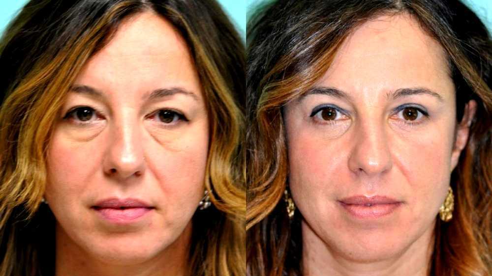 Blepharoplasty