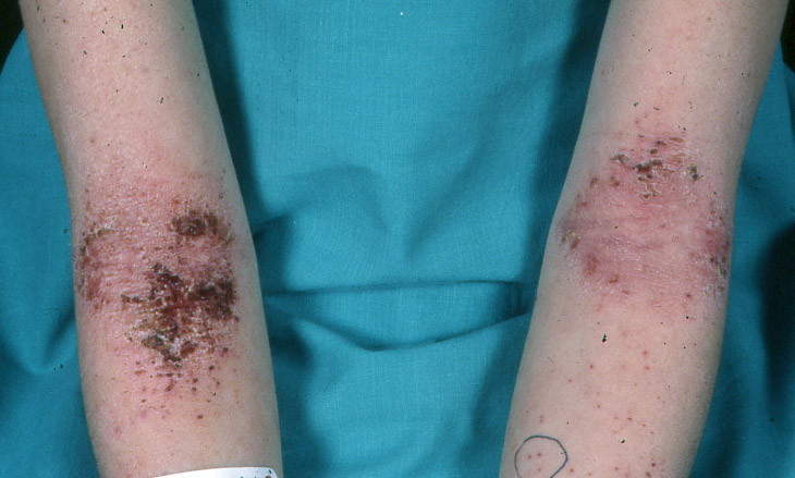 Medical Student: Dermatitis Atopik