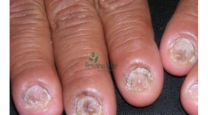 Podologia e Reflexologia: Onicomicose (micose (fungos) de unhas)