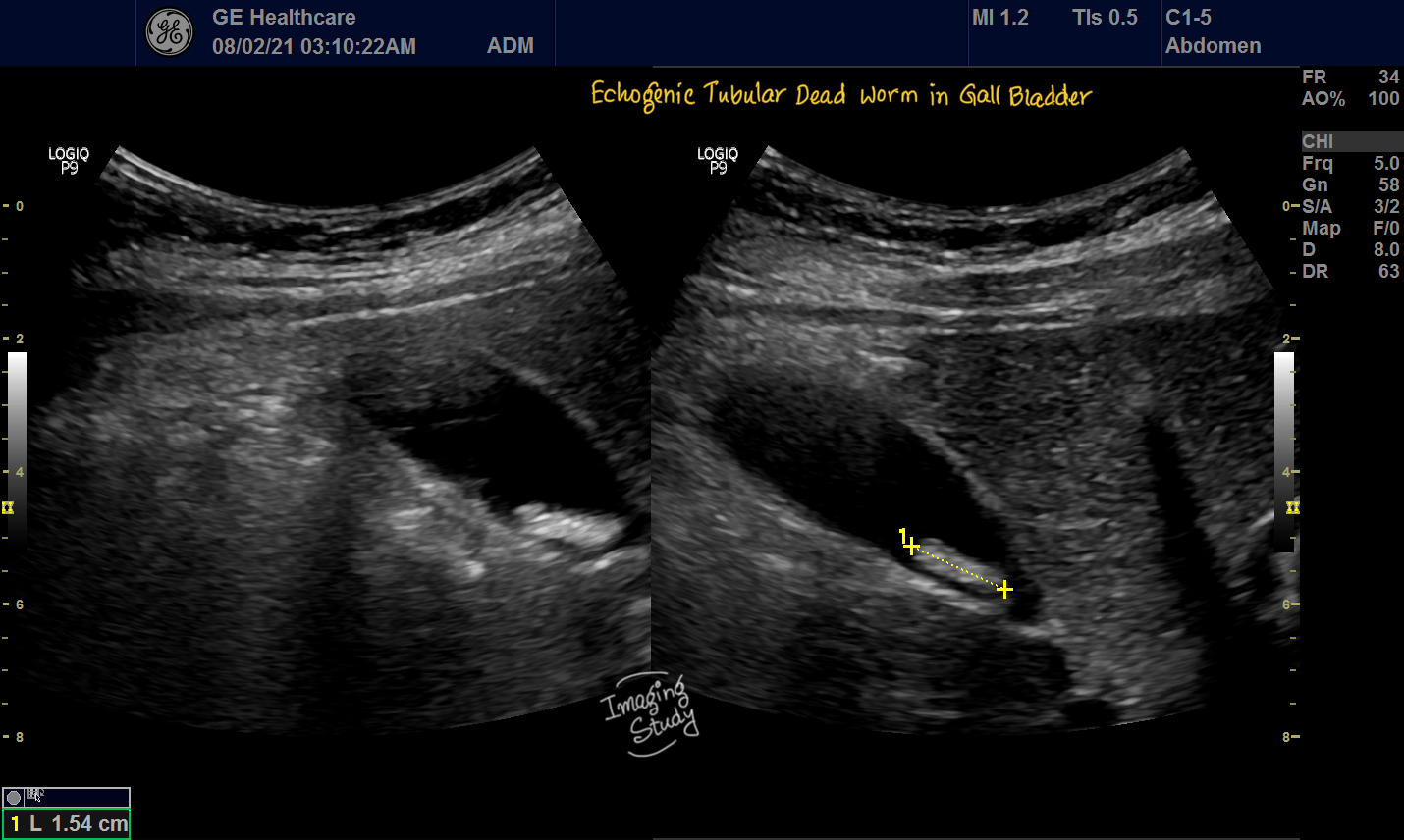 Case 31: Worm in Gallbladder - Biliary Ascariasis ~ Imaging Study