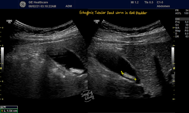 Case 31: Worm in Gallbladder - Biliary Ascariasis ~ Imaging Study