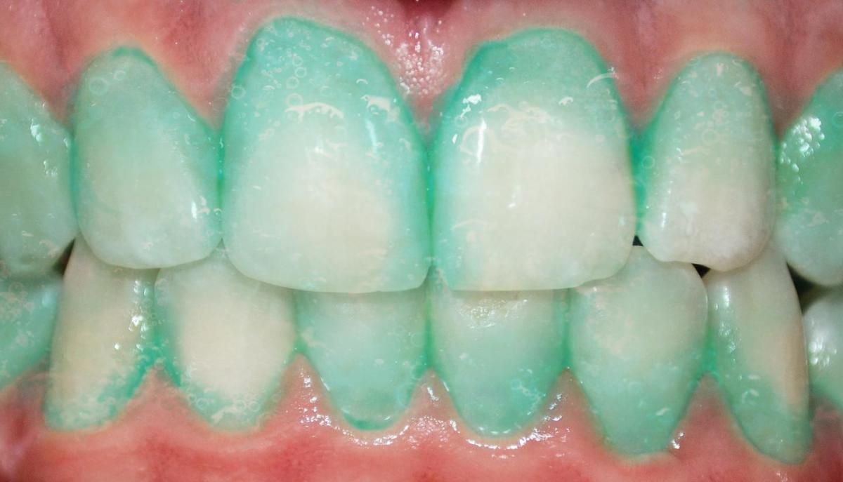 Cleaner Teeth Linked To Lower Systemic inflammation in Foothpaste Study